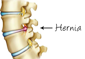 Wat is een hernia? - Soorten en Behandeling - Orthocor Blog